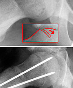 EPIFISIOLISIS FEMORAL CAPITAL - TUTRAUMATOLOGO.COM